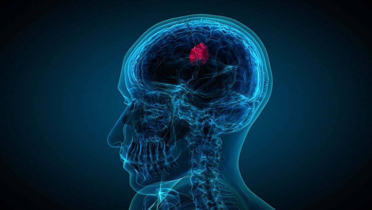 Un Nuevo Método Elimina Tumores Cerebrales Al Matarlos De Hambre Dr